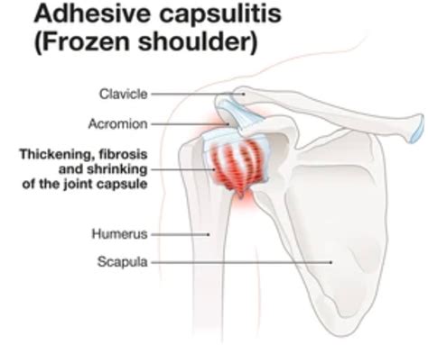 Discover The Power Of Shoulder Hydrodilatation For Frozen Shoulder Relief