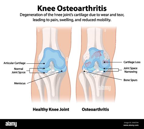 Healthy Knee Vs Osteoarthritis Affected Knee Diagram Stock Vector Image
