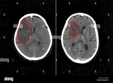 Brain Stroke CT Scan Stock Photo Alamy