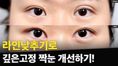 깊은고정 소시지눈 짝눈 한번에 개선하는 라인낮추기 두줄따기 Youtube