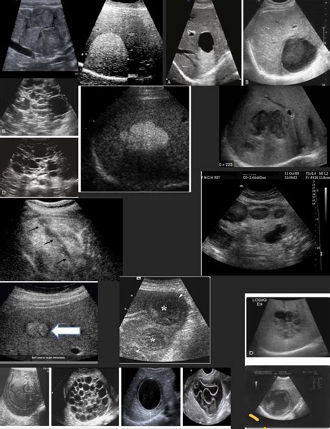 HEPATIC DISEASE DIAGRAM Diagram Quizlet