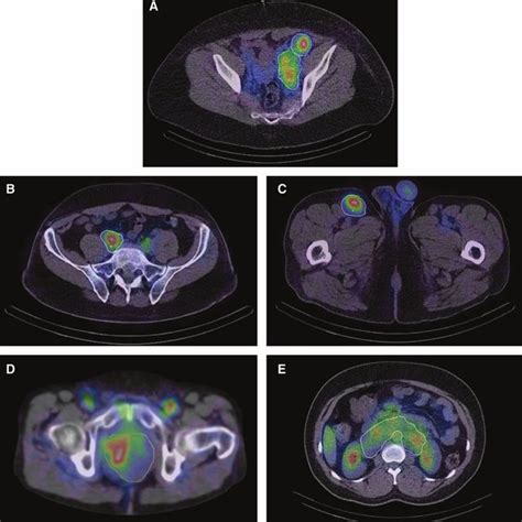 Fused Single Photon Emission Computed Tomography Spect And Computed Download Scientific