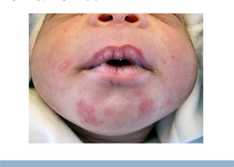 Peds Derm Flashcards Quizlet