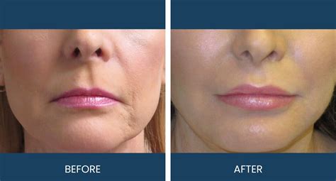 Upper Lip Lift Plano Plastic Surgery