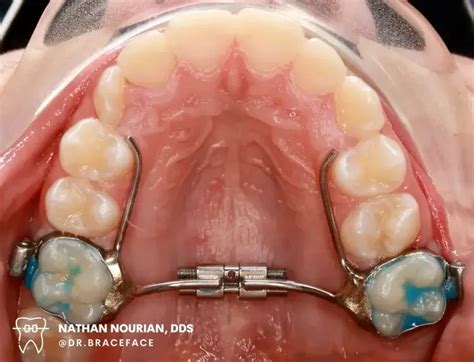 Palatal Expander In Los Angeles Ca