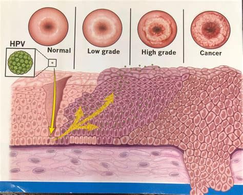 Normal Vs Abnormal Pap Smears