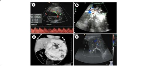 Fetus With A Hemangioma In The Left Liver Lobe Fetus 1 A Circular