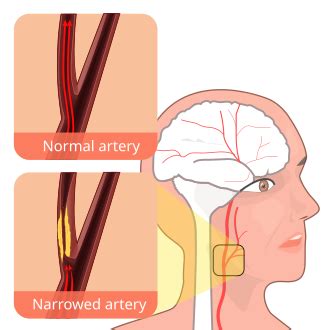 Carotid Artery Stenosis Wikiwand