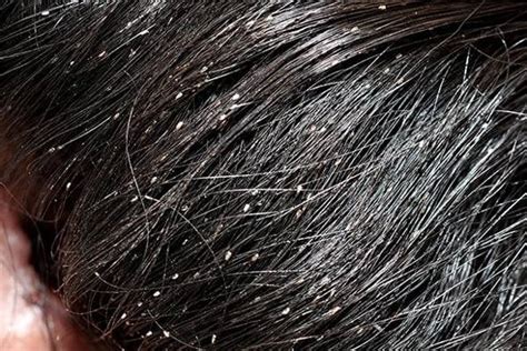 பேன் ஈறு தொல்லைக்கு இன்றோடு முடிவு கட்டும் கை மருந்து எப்படி செய்யணும் தெரியுமா மனிதன்