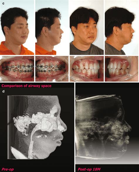 Strategy For Class Ii Orthognathic Surgery Orthodontic Perspective