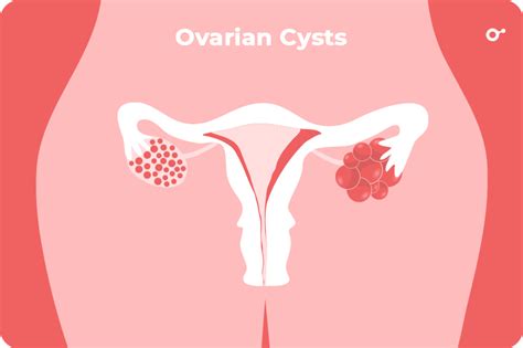Uterine Cysts