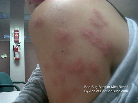 Mite Bites On Humans