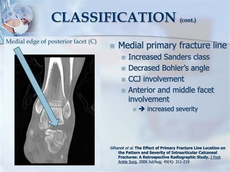 Ppt Minimally Invasive Fixation Of Calcaneal Fractures Powerpoint Presentation Id 2681227
