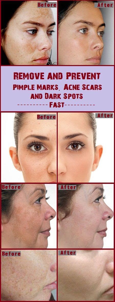 How To Remove Pimple Marks And Acne Marks From Face