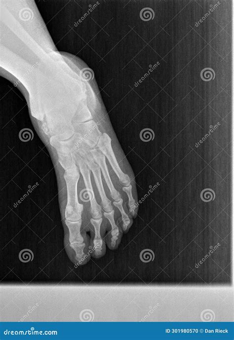 Film Xray Or Radiograph Of A Normal Foot Ankle And Leg Dorsal