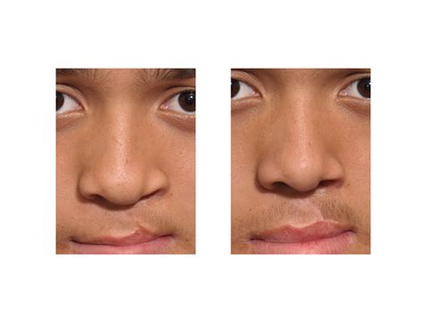 Cleft Nose Tip