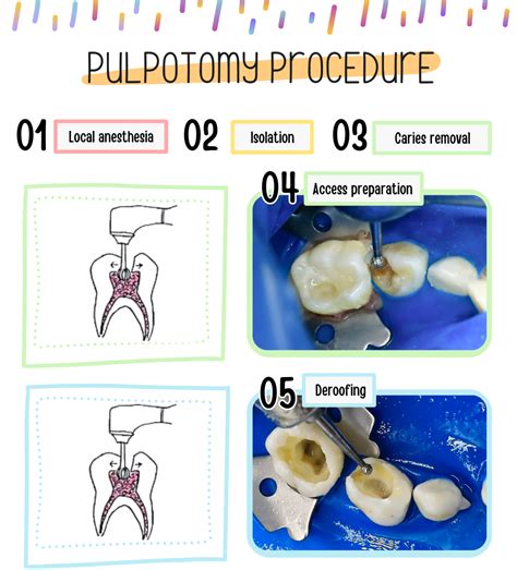 Pulpotomy Procedure Pediatric Dentistry Workbook