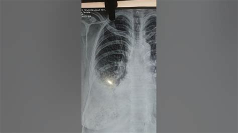 Pneumonia With Parapneumonic Effusion Youtube