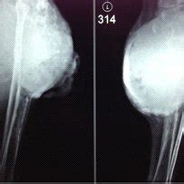 A Radiograph Showing Osteosarcoma Of The Distal Tibia In A Year Old Download Scientific