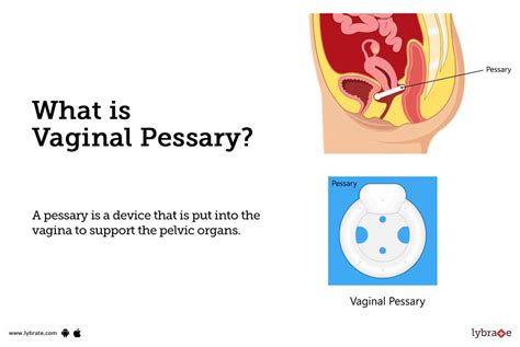 Pessary Types And How To Use 49 Off Gt