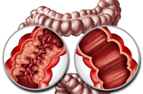 Types Of Ileostomy Procedures And Possible Risks Health Detox