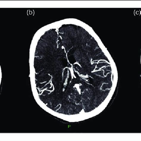 Multiphase Computed Tomography Angiography Mcta Images Represent The Download Scientific