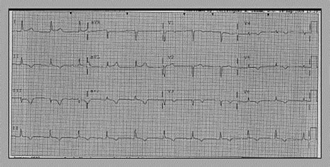 EKG T Wave Inversions In II III AVF And QS Complexes T Wave Download Scientific Diagram