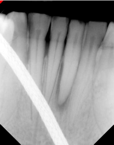 L7 Digital Radiographic Errors Flashcards Quizlet