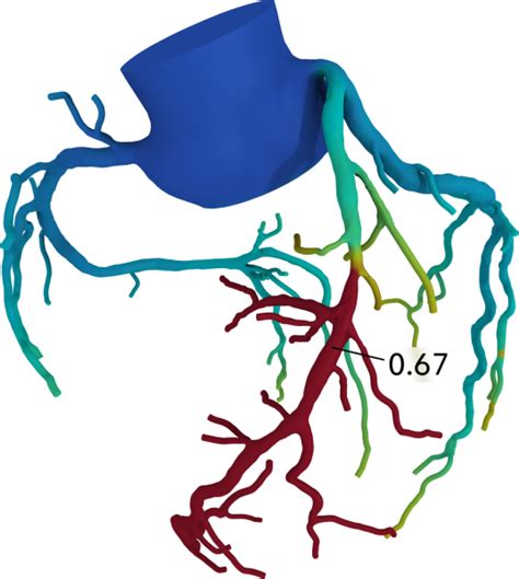 Nitish J On Linkedin More Effective Non Invasive Test Uses Artificial Intelligence To Detect…