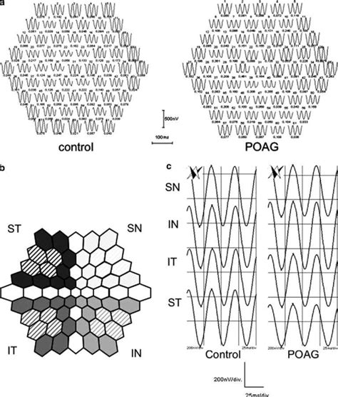 A The Response Arrays From A Representative Poag Patient With A Mean