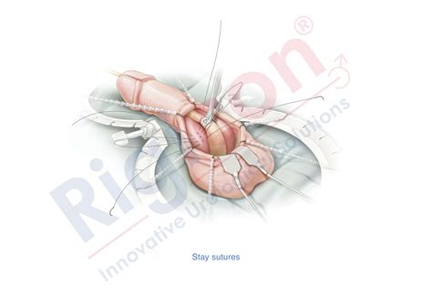 Infla10® Pulse™ Series Inflatable Penile Prosthesis
