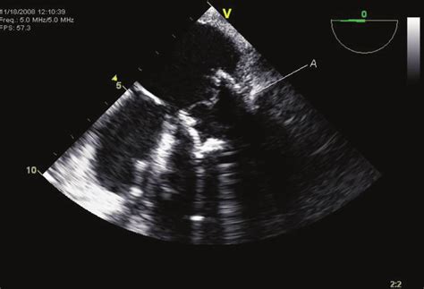 Postoperative Transesophageal Echocardiogram Demonstrating The Mitral