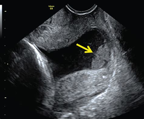 Dilated Cervix Ultrasound