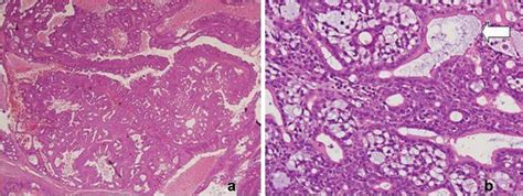 Hande Staining Of Nmu Induced Rat Mammary Carcinoma A Papillary Download Scientific Diagram