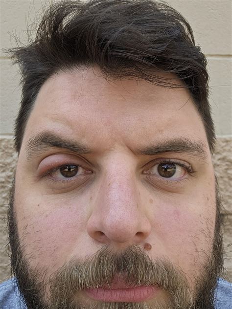 On Day 2 Of A Kenalog Injection For My Chalazion Doc Said Warm Compress 3x Day 10min Follow Up