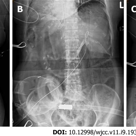Intraoperative Cholangiograms During Transcystic Choledocholithotripsy