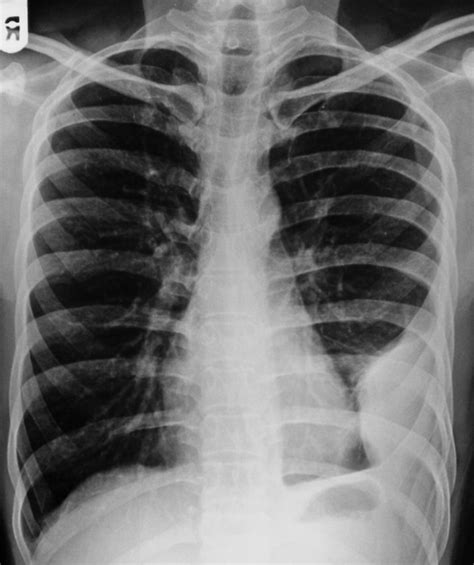Loculated Pleural Effusion Ct Cureus Recurrent Large Volume Malignant