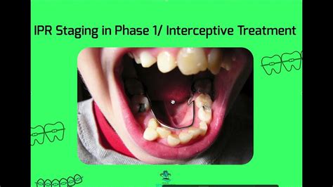 Ipr Staging In Interceptive Ortho Youtube