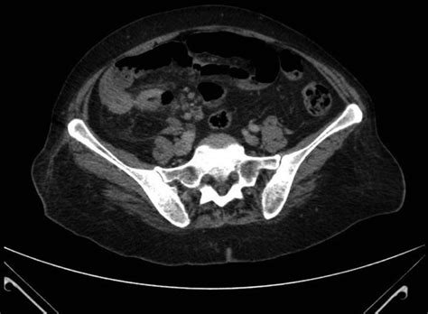 Multisystemic Tuberculosis Presenting With Scrofula Intestinal And Multisystemic Tuberculosis Presenting With Scrofula Intestinal And