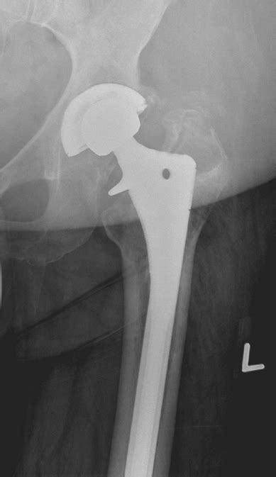 Ankle Fractures Open Reduction Internal Fixation Teachme Orthopedics