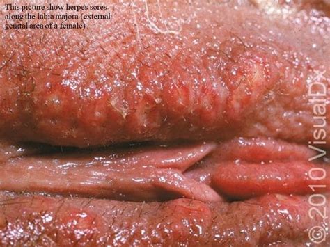 Herpes Photos In Different Stages