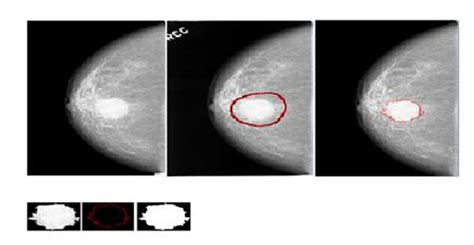 Roi Segmentation With Mammogram The First Line Showing From Left To Download Scientific