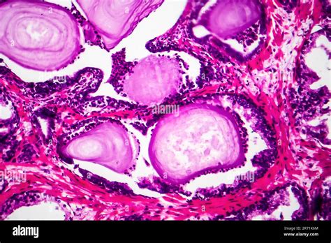 Benign Prostatic Hyperplasia Light Micrograph Photo Under Microscope