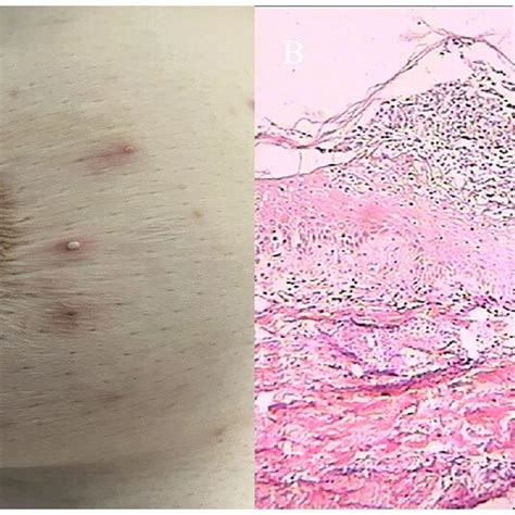 A Pustules On The Right Side Of The Chest B Histopathology On The Download Scientific