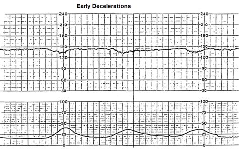 Early Decelerations Explained