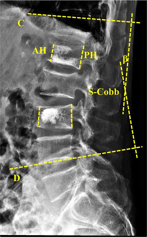 Measurements Of Sagittal Segmental Cobb S Cobb And The Vertebral Download Scientific Diagram