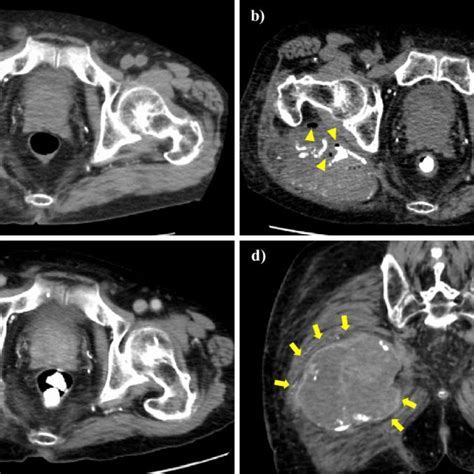 Figure1 The Findings Of Abdominal Computed Tomography A Axial Download Scientific Diagram
