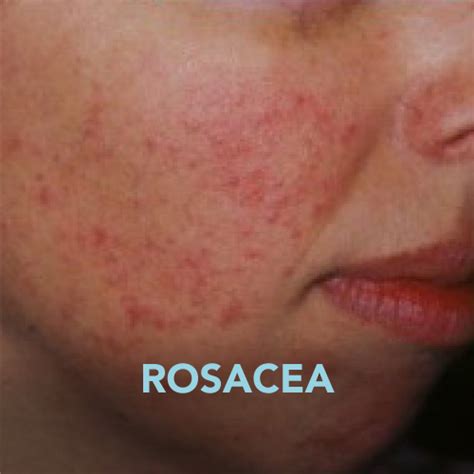 Discoloration And Other Skin Treatments Dermatology Consultants