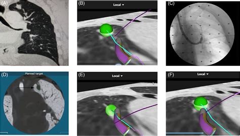 Improved Diagnostic Yield For Lung Nodules With Digital Tomosynthesis