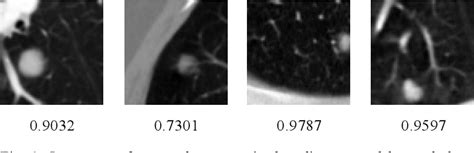 Figure 6 From Classification Of Lung Nodules Using Convolutional Long Short Term Neural Network